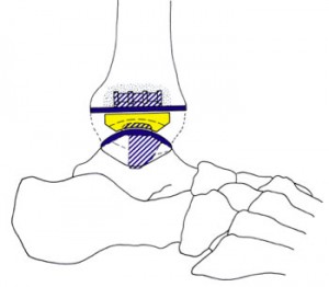 STAR Ankle Replacement | Ankle Arthritis | Vail, Frisco, Denver CO